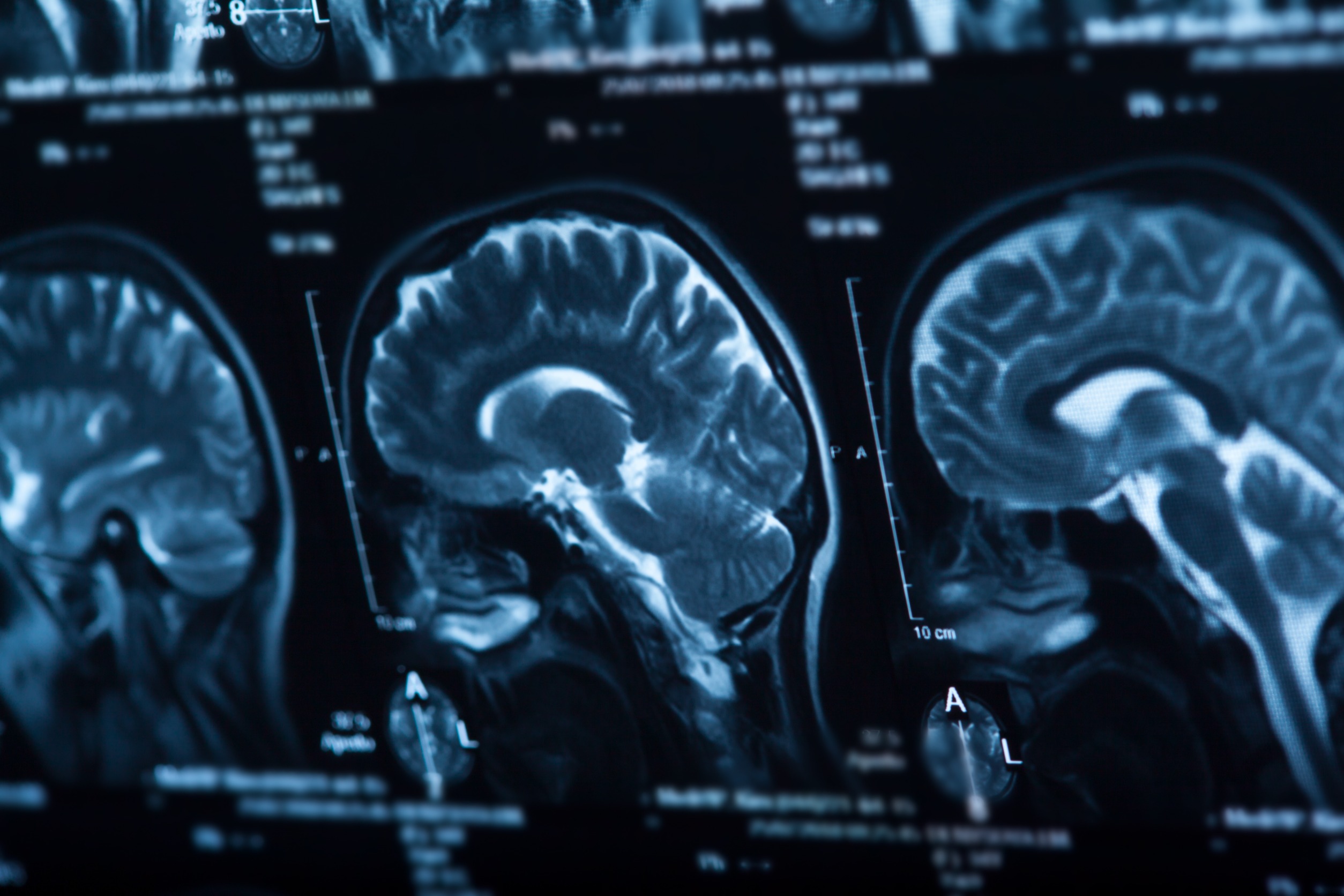 Coup and Contrecoup Brain Injuries